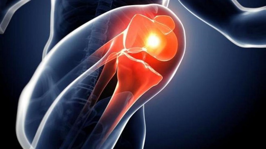 ¿Cuáles son las causas y síntomas de la artrosis? | TVPerú