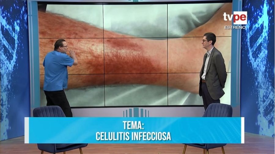 Recomendaciones para proteger tu piel de la celulitis infecciosa
