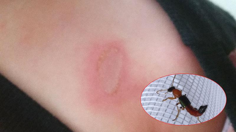 Picaduras de insectos pueden convertirse en grave riesgo | TVPerú