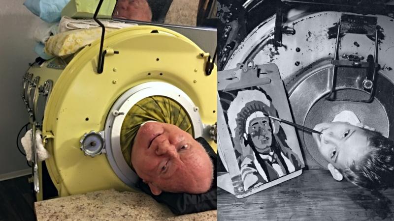 "Polio Paul" fallece a los 78 años: Paul Alexander vivía con un "pulmón ...